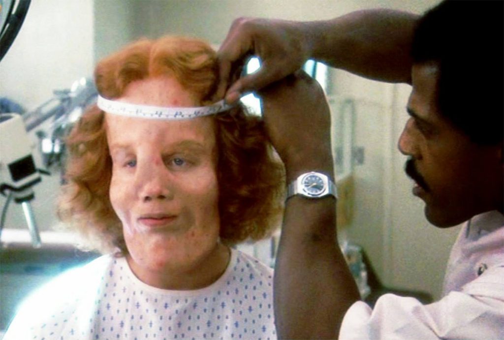 10 Heart-Rending Facts About Rocky Dennis, Whose Rare Deformity Was The ...